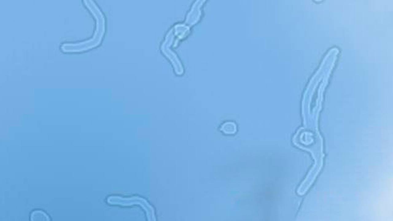 Doctor shares essential steps to take when you notice eye floaters