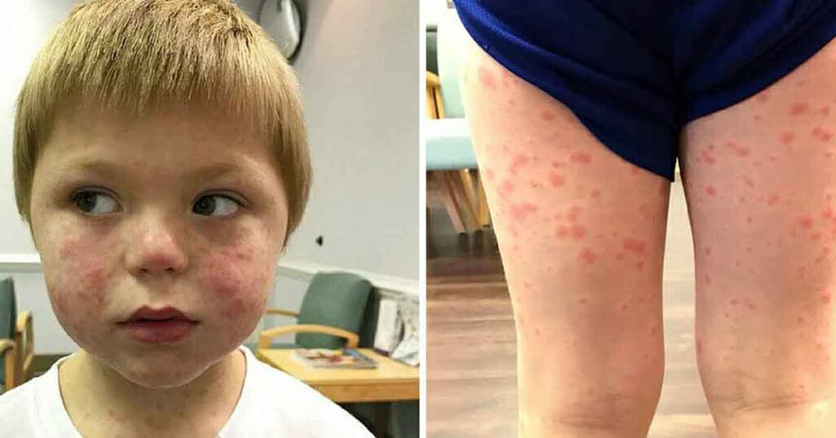 Mom discovers doctor’s dangerous mistake after son’s sudden full-body rash