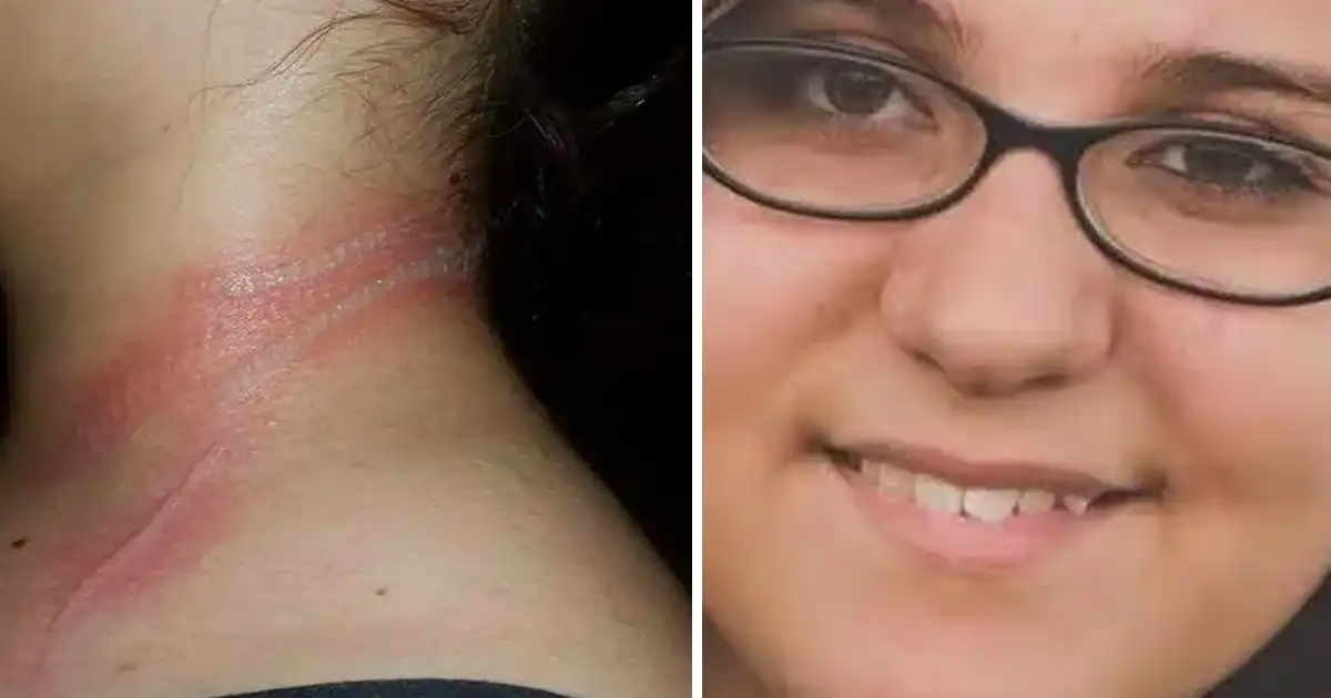 Teen girl suffers severe neck burns after using phone while it was charging