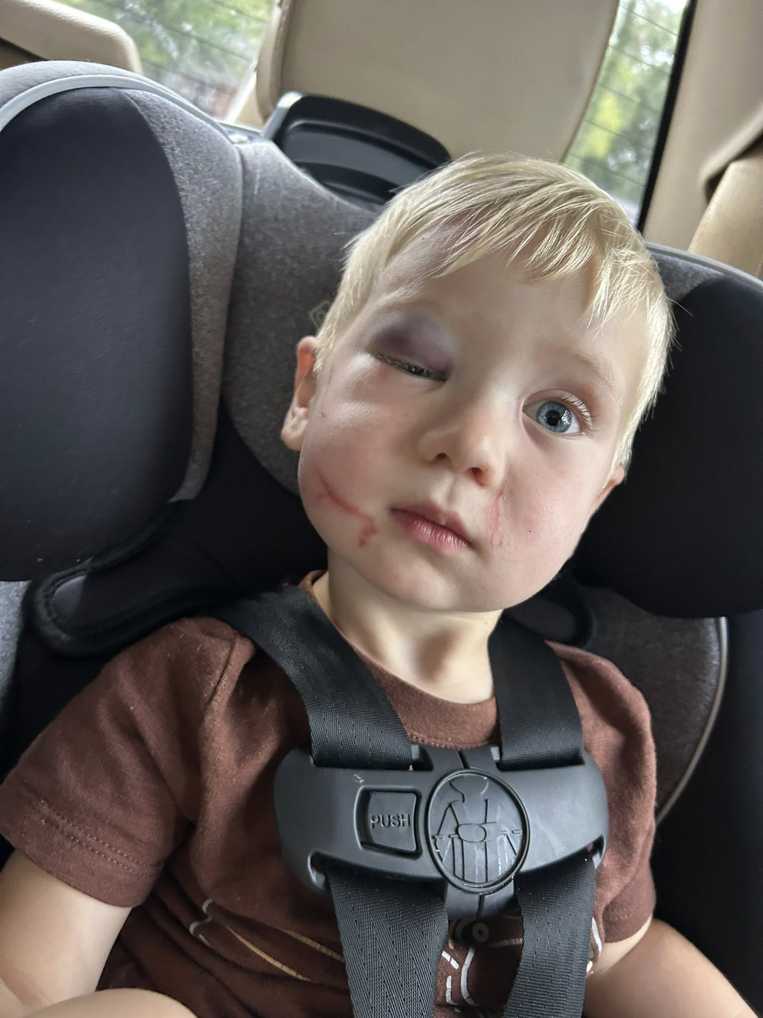 Daycare worker arrested after toddler’s first day ends with black eye ...