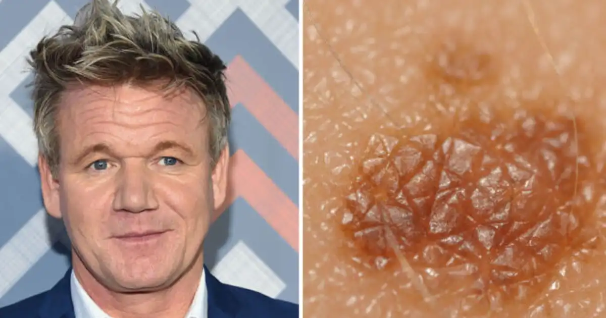 Gordon Ramsay warns fans about skin cancer after surgery