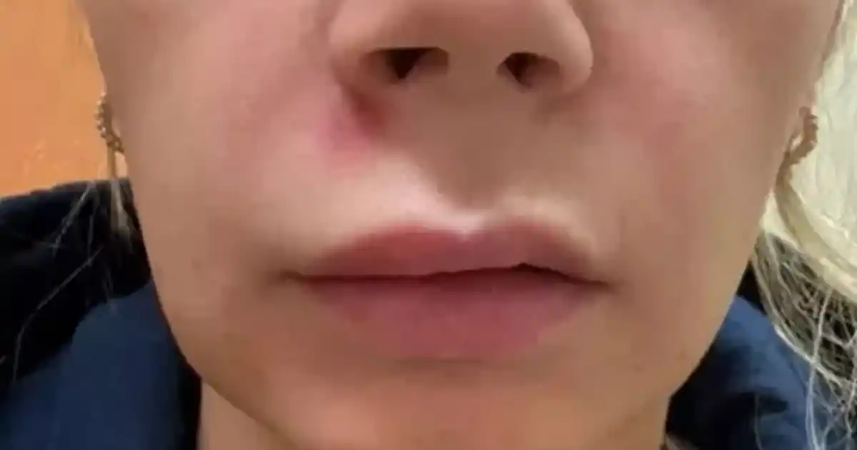 Doctors warn against popping pimples in the ‘triangle of death’—here’s why