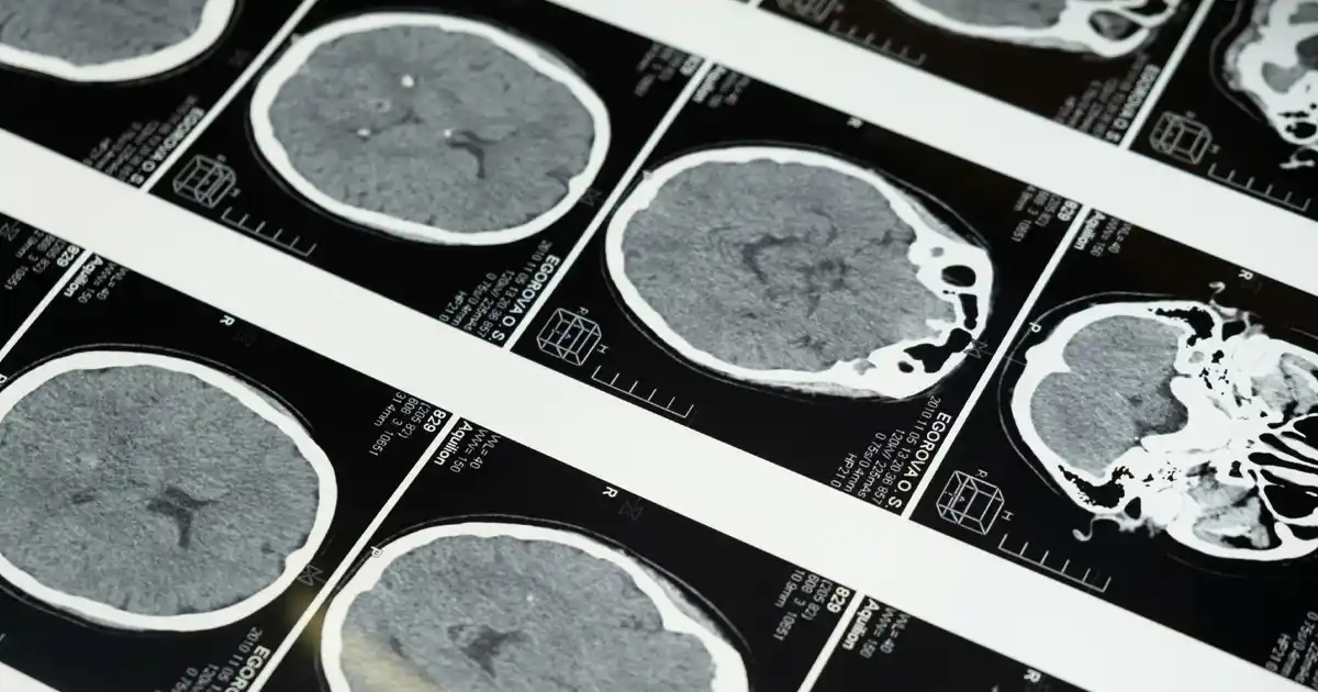 Could gum disease be a hidden trigger for Alzheimer’s?